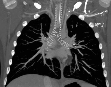 Two Cases of Warfarin-Induced Tracheobronchial Calcification After ...