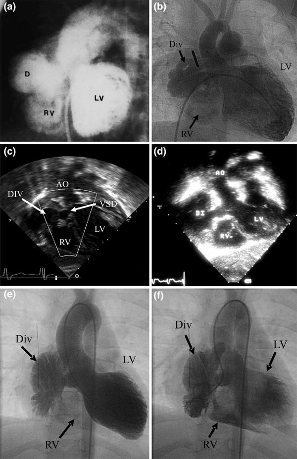 Anterosuperior Diverticula of the Right Ventricle: Morphological ...