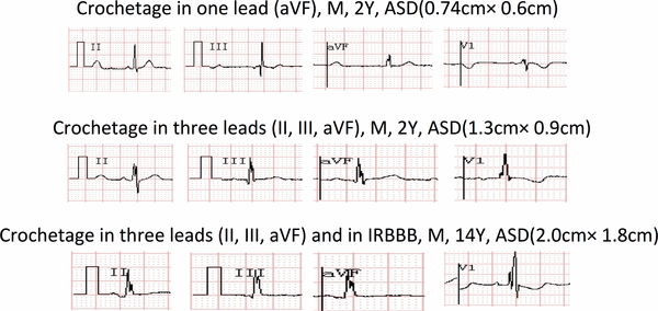 The Significance of Crochetage on the R wave of an Electrocardiogram ...
