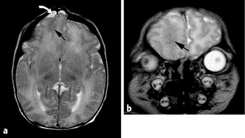 Congenital frontonasal masses: developmental anatomy, malformations ...