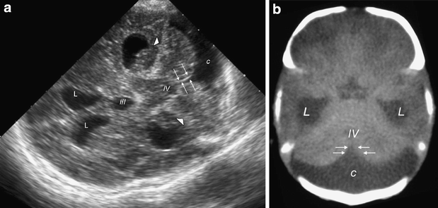 Mastoid fontanelle approach for sonographic imaging of the neonatal ...