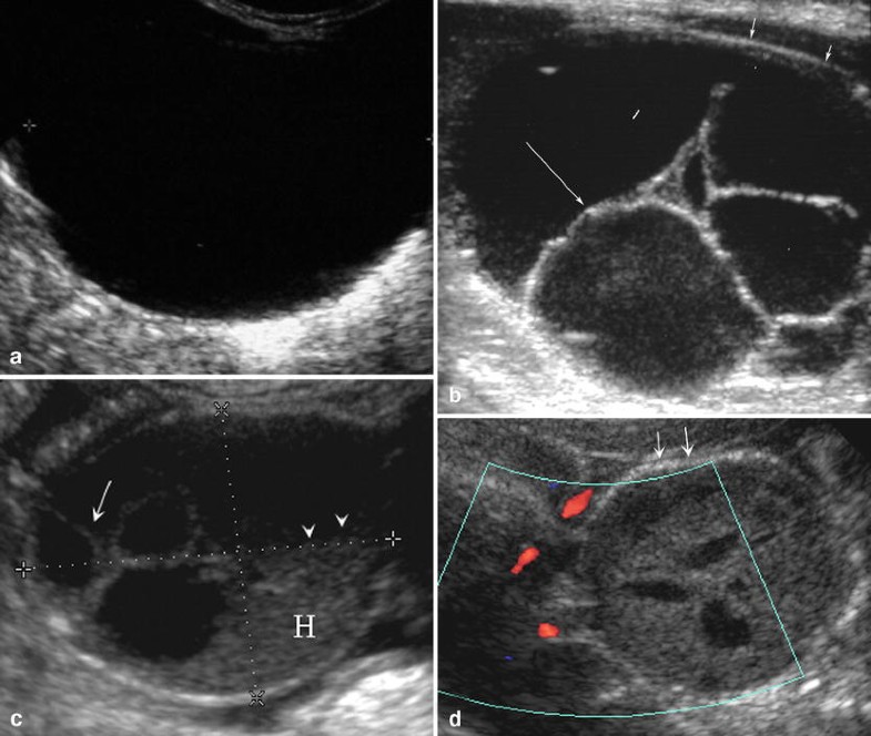 Percutaneous drainage as the treatment of choice for neonatal ovarian ...