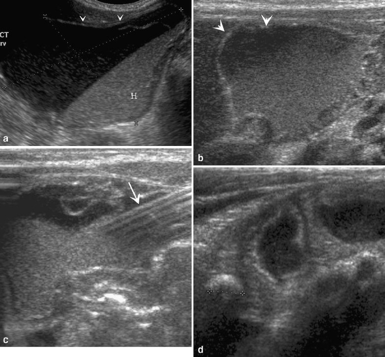 Percutaneous drainage as the treatment of choice for neonatal ovarian ...