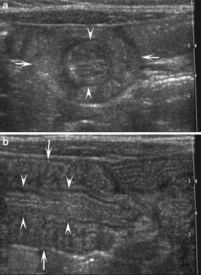 Ileoileal intussusception in children: ultrasonographic differentiation ...
