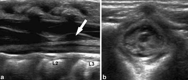 Isolated filar cyst on lumbar spine sonography in infants: a case ...