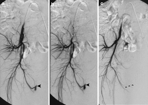 Priapism in children: treatment with embolotherapy | SpringerLink