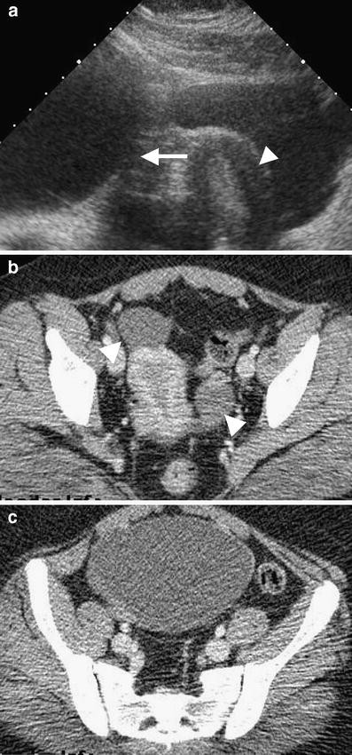 Isolated fallopian tube torsion: sonographic and CT features | SpringerLink