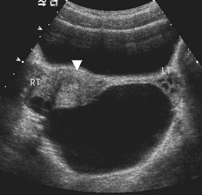 Isolated fallopian tube torsion: sonographic and CT features | SpringerLink