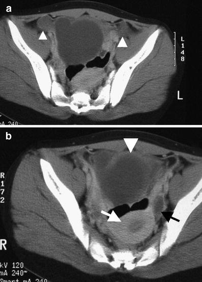 Isolated fallopian tube torsion: sonographic and CT features | SpringerLink