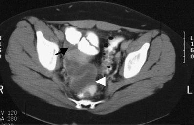 Isolated fallopian tube torsion: sonographic and CT features | SpringerLink