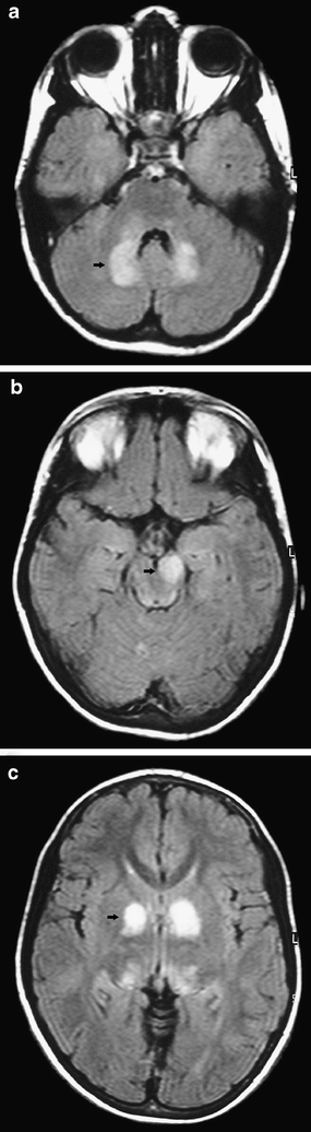 Unidentified bright objects on brain MRI in children as a diagnostic ...
