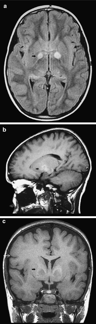 Unidentified bright objects on brain MRI in children as a diagnostic ...