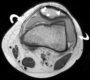 The patellar extensor apparatus of the knee | SpringerLink