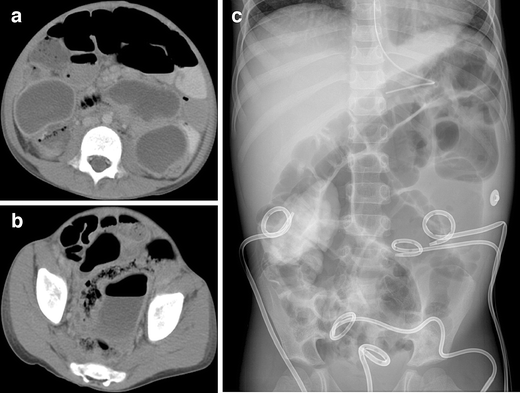 Image-guided drainage of multiple intraabdominal abscesses in children ...