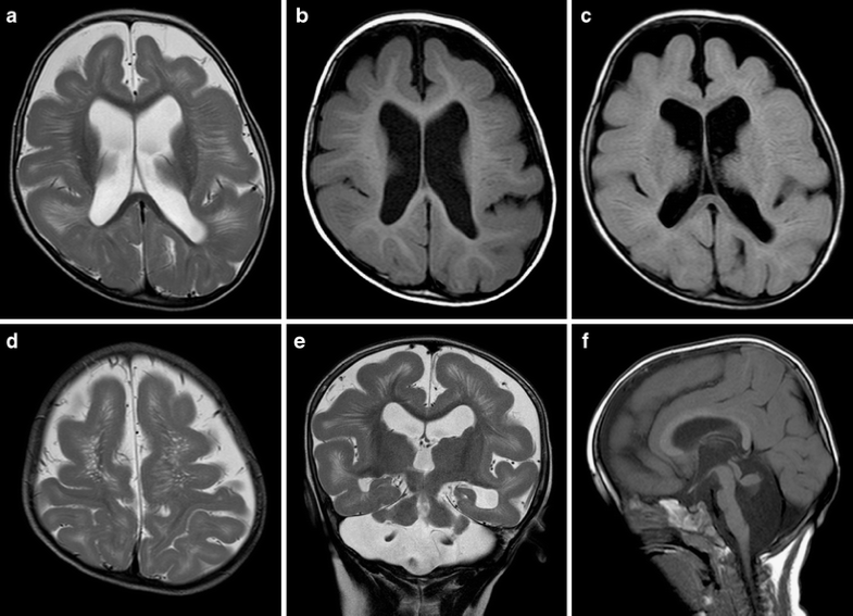 Tigroid pattern of the white matter: a previously unrecognized MR ...