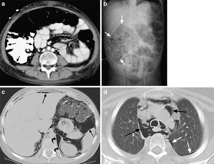 Clinical and CT features of benign pneumatosis intestinalis in ...