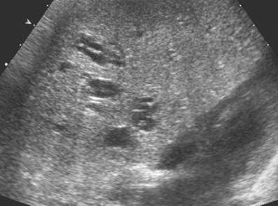 Caroli disease and the central dot sign | SpringerLink