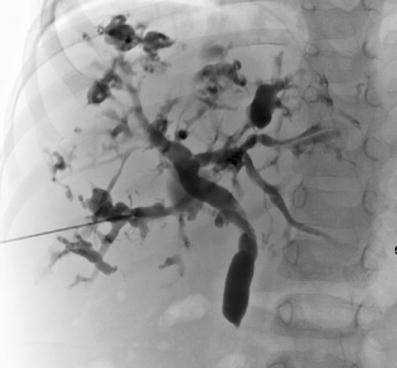 Caroli disease and the central dot sign | SpringerLink