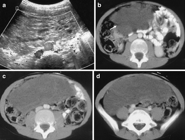 Embryonal rhabdomyosarcoma of the omentum: two cases occurring in ...