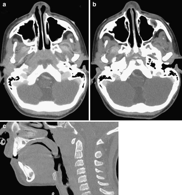 Clival osteomyelitis resulting from spread of infection through the ...