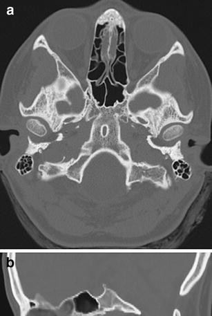 Clival osteomyelitis resulting from spread of infection through the ...