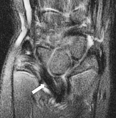 Madelung deformity with Vickers ligament | SpringerLink