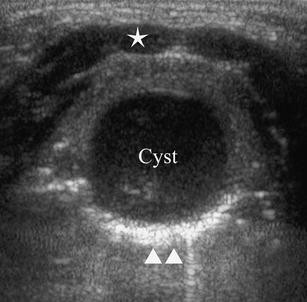 Vallecular cyst as a cause of congenital stridor: report of five ...
