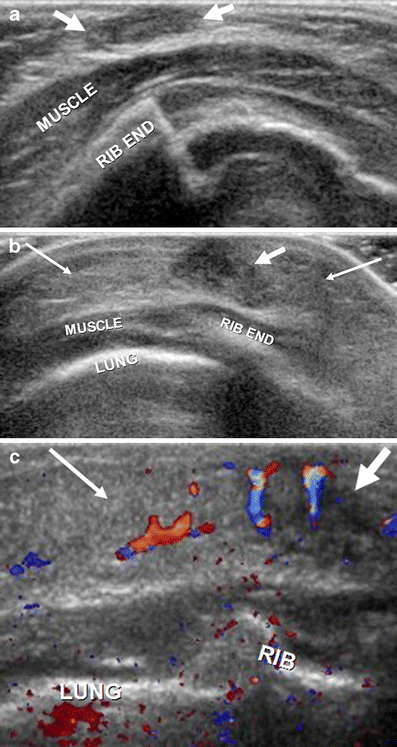 Sonographic features of neonatal mastitis and breast abscess | SpringerLink