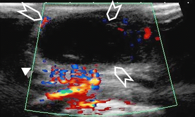 Sonographic features of neonatal mastitis and breast abscess | SpringerLink