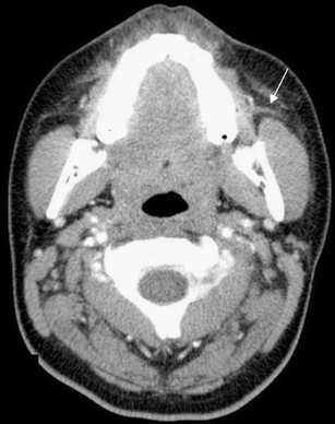 Aplasia of the parotid glands with accessory parotid tissue | SpringerLink