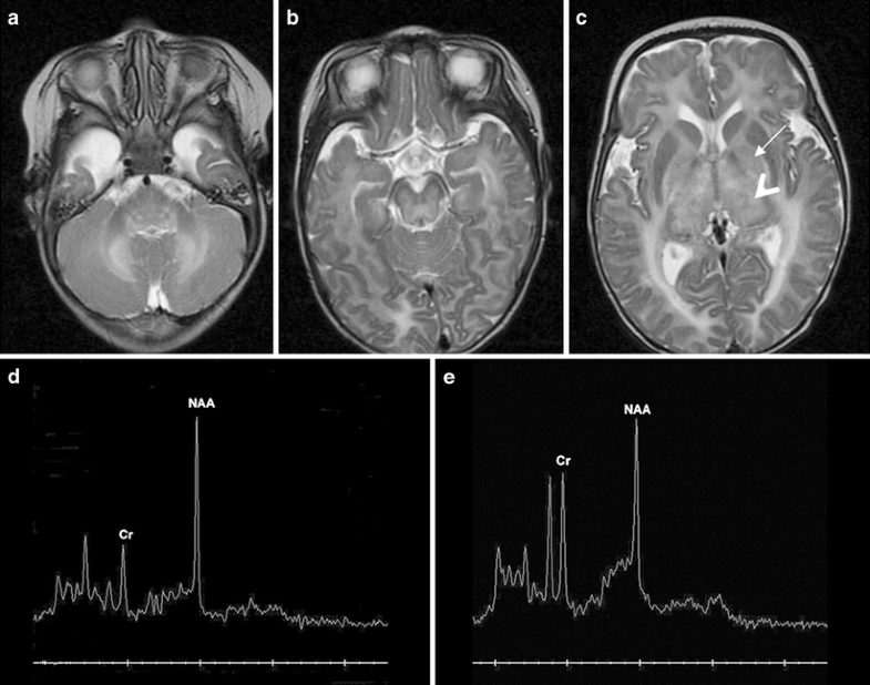 The dentate nucleus in children: normal development and patterns of ...