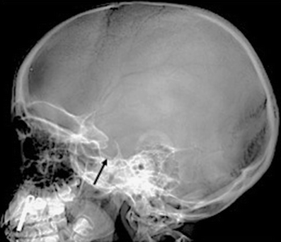 Enlarged sella of primary childhood hypothyroidism | SpringerLink