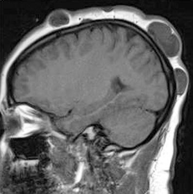 Multiple scalp epidermoid cysts in a child with Gardner syndrome ...