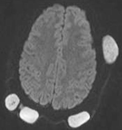 Multiple scalp epidermoid cysts in a child with Gardner syndrome ...