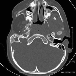 First and second branchial arch syndromes: multimodality approach ...