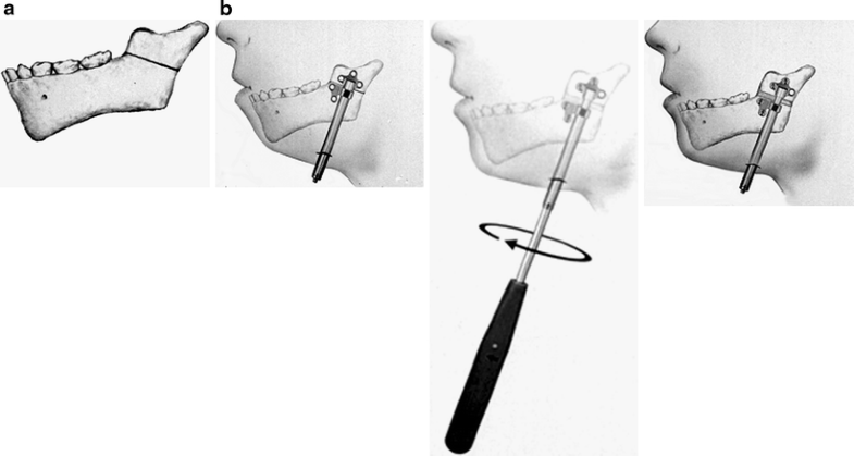 First and second branchial arch syndromes: multimodality approach ...