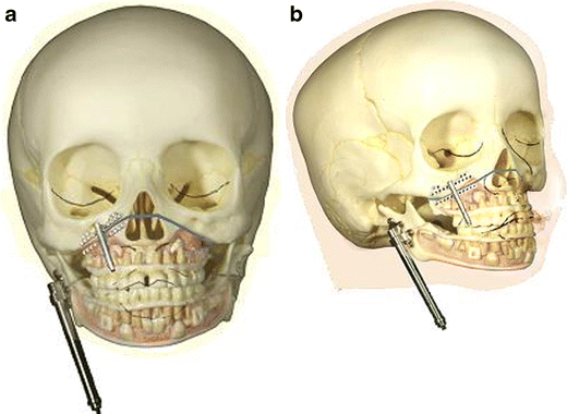 First and second branchial arch syndromes: multimodality approach ...