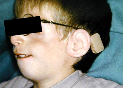 First and second branchial arch syndromes: multimodality approach ...