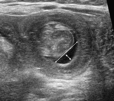 Interloop fluid in intussusception: what is its significance ...