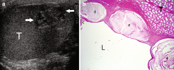 Testicular epidermoid cysts in children: sonographic characteristics ...