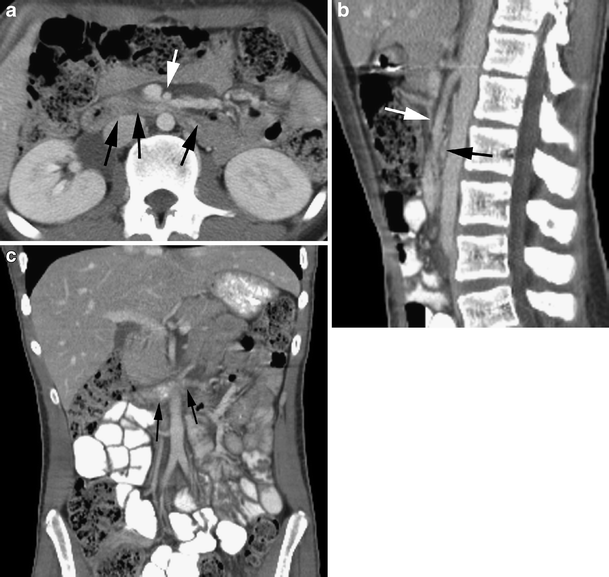 CT appearance of the duodenum and mesenteric vessels in children with ...