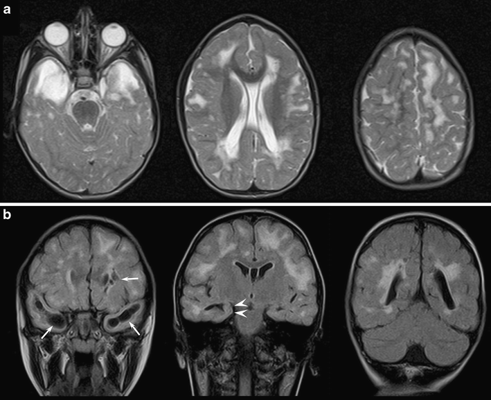 Brain magnetic resonance findings in symptomatic congenital ...