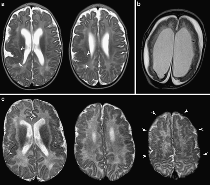 Brain magnetic resonance findings in symptomatic congenital ...