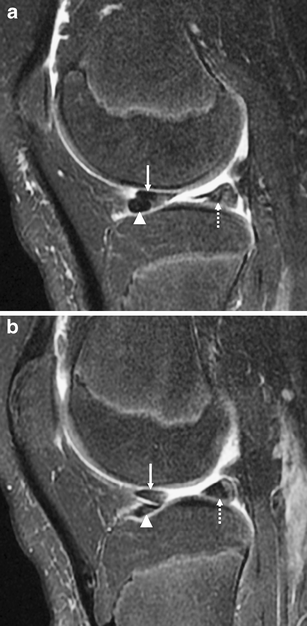 MRI of displaced meniscal fragments | SpringerLink
