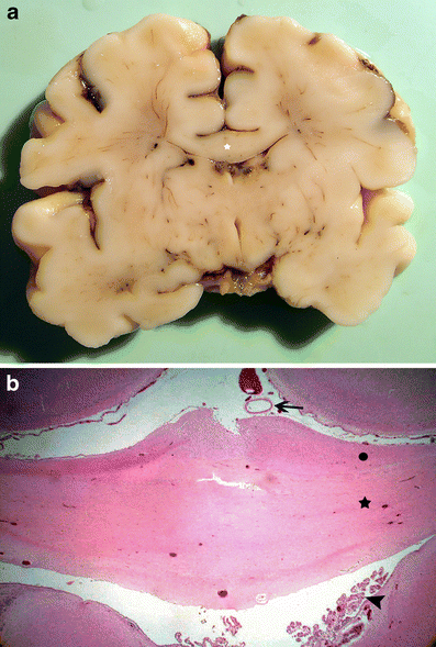 Thick corpus callosum: a clue to the diagnosis of fetal septopreoptic ...