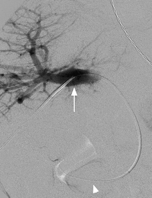 Pre- and postoperative imaging and interventions for the meso-Rex ...