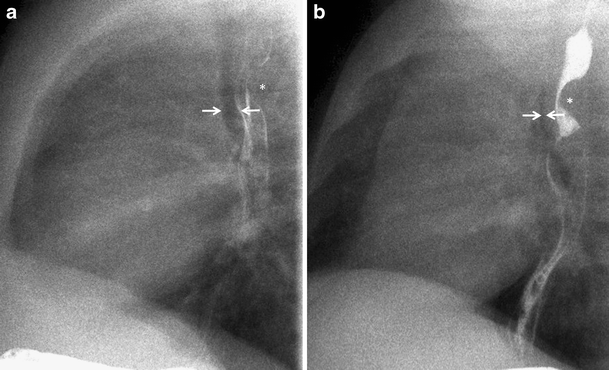 Tracheobronchomalacia in children: review of diagnosis and definition ...