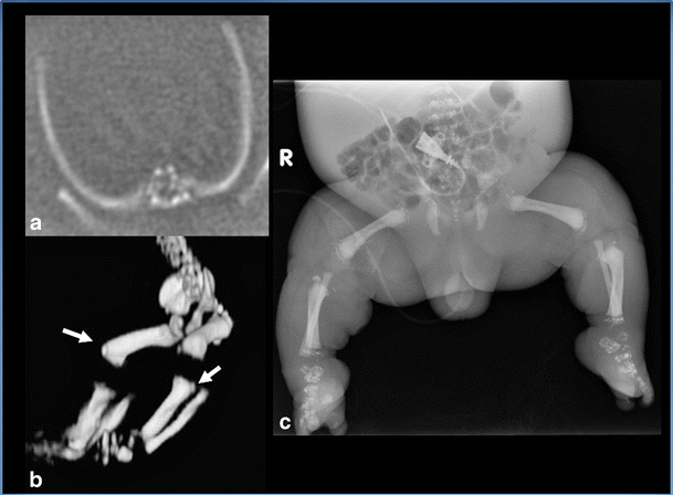 Prenatal diagnosis of fetal skeletal dysplasia with 3D CT | SpringerLink