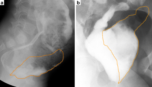 Contrast enema findings in patients presenting with poor functional ...