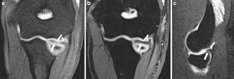 Elbow plica syndrome: presenting with elbow locking in a pediatric ...